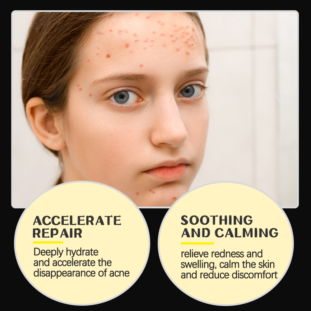 400Pcs Pimple Patches for Face, Hydrocolloid Acne Patches Zit Patches ...