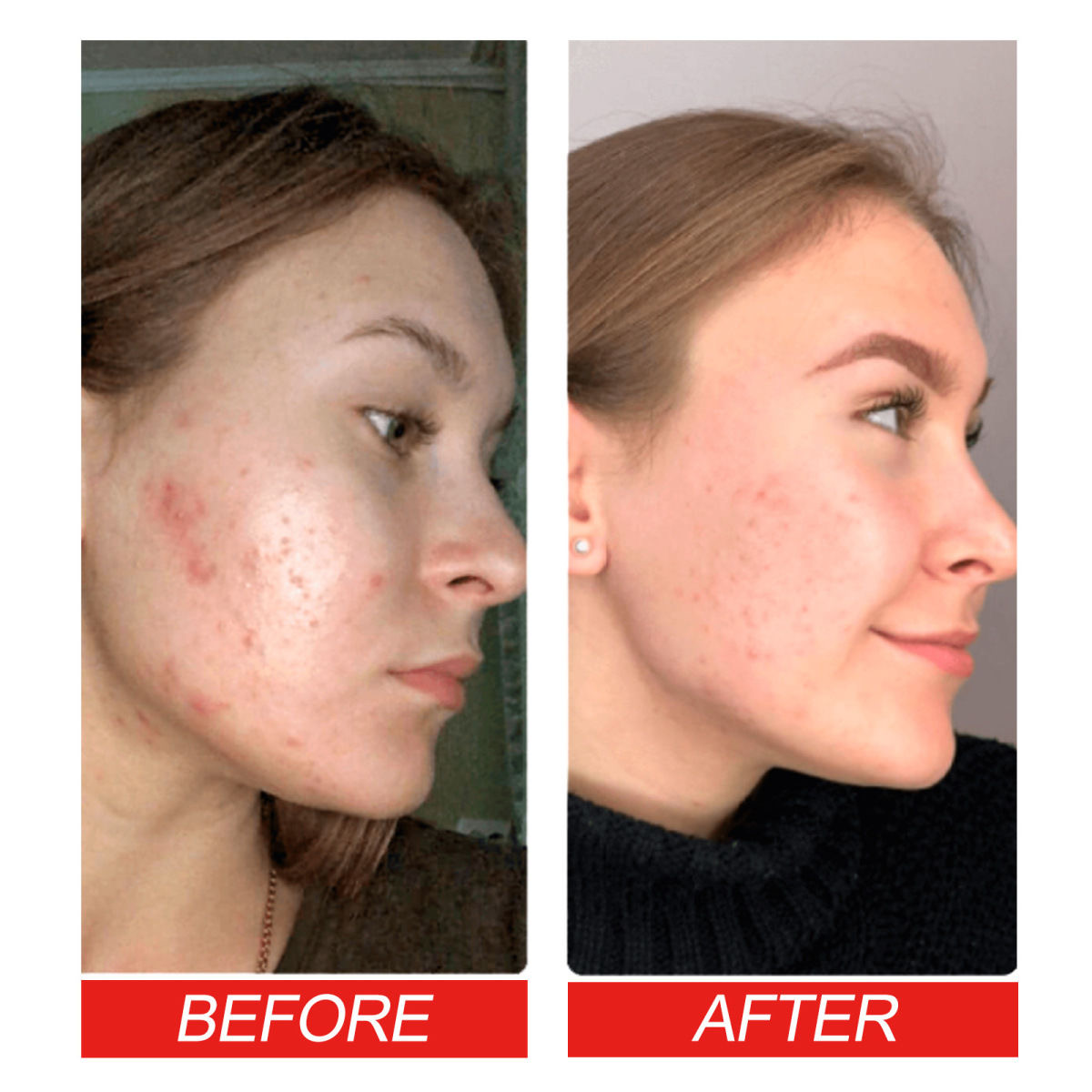 BYE BYE ACNE Essence Salicylic Acid Anti-Acne Serum, Acne Scar ...