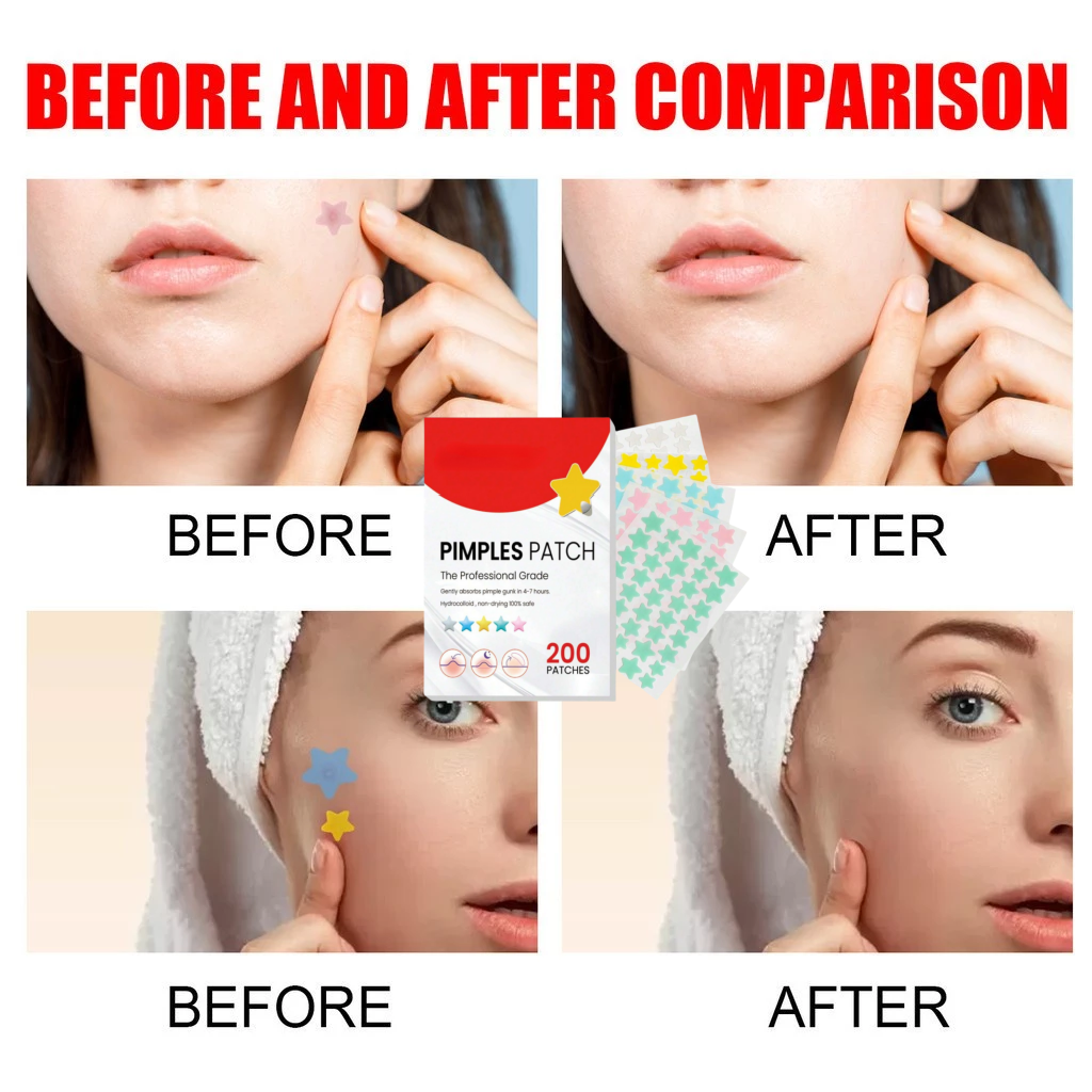200pcs Star Pimple Patch Acne Colorful Invisible Acne Removal Skin Care ...