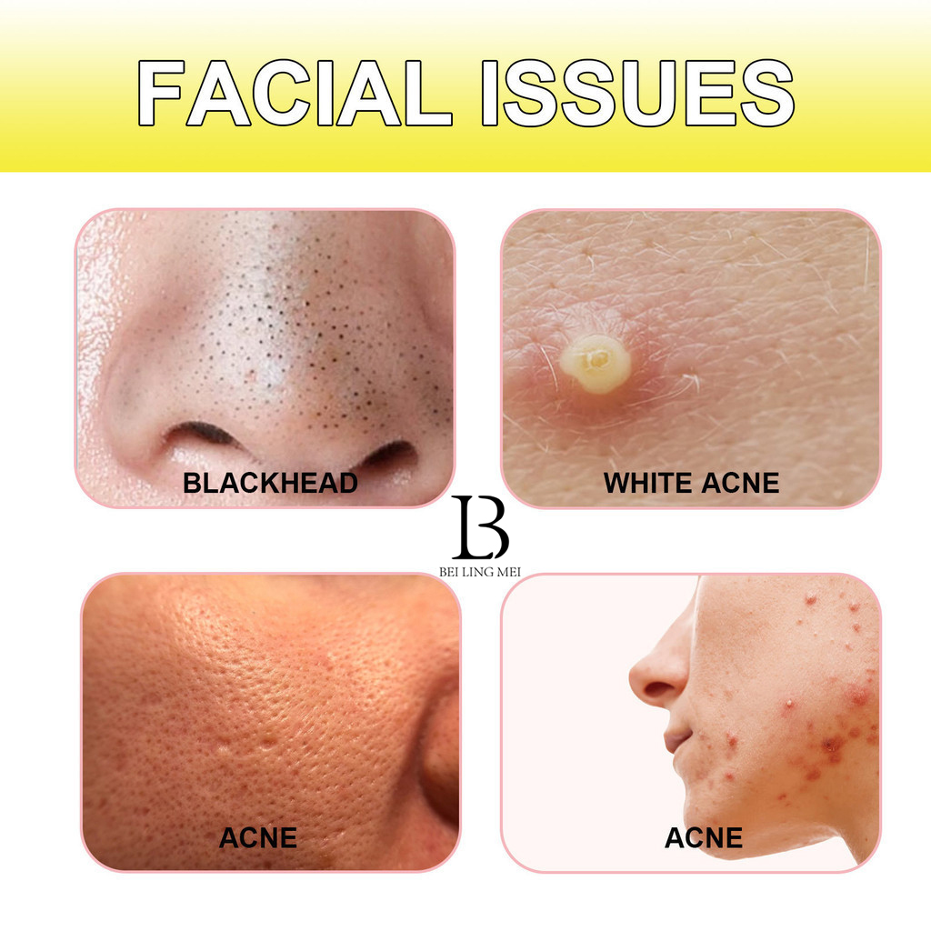 144Pcs Wiieey Acne Patch Series Fading Acne Marks Cleansing And Closing ...