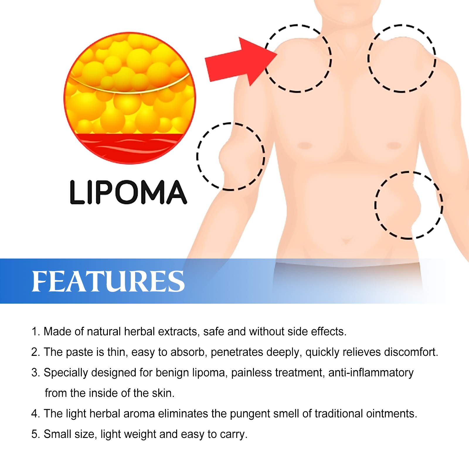 New Lipoma Removal Cream, Relieve Cream for Inflammation, Fibroids ...