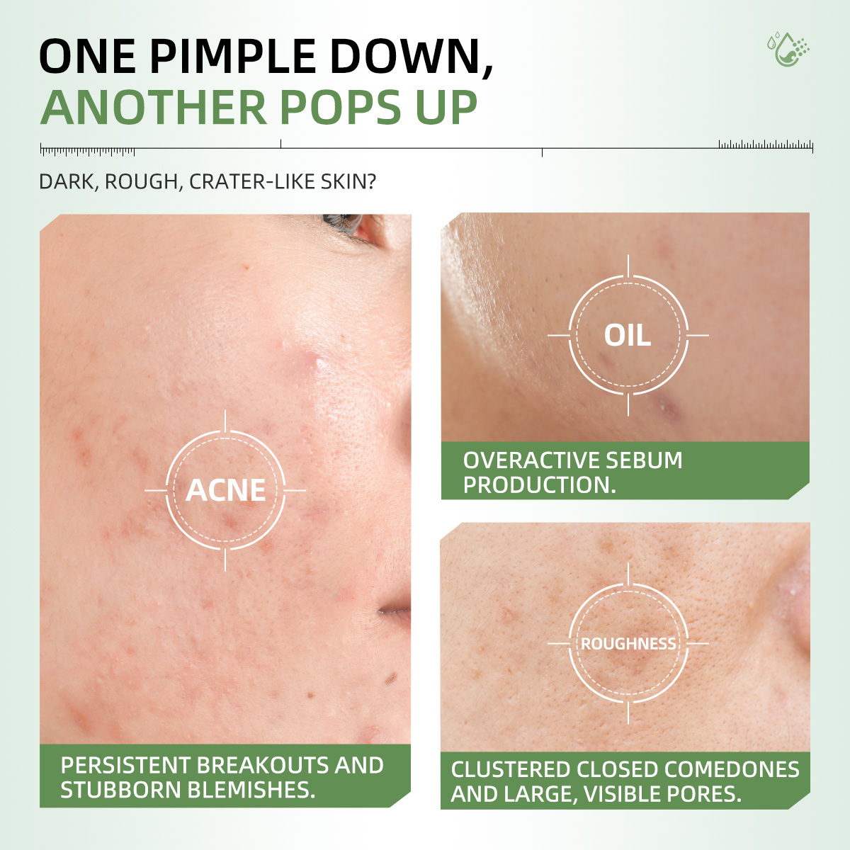 【Targeted Acne Solution】JMCY× TEASHELL Acne clearing & Oil-Control ...