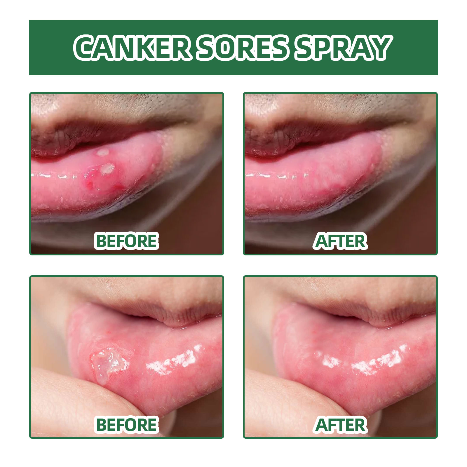 Natural Extract Antibacterial Mouth Spray for Oral Care, Ulcers ...
