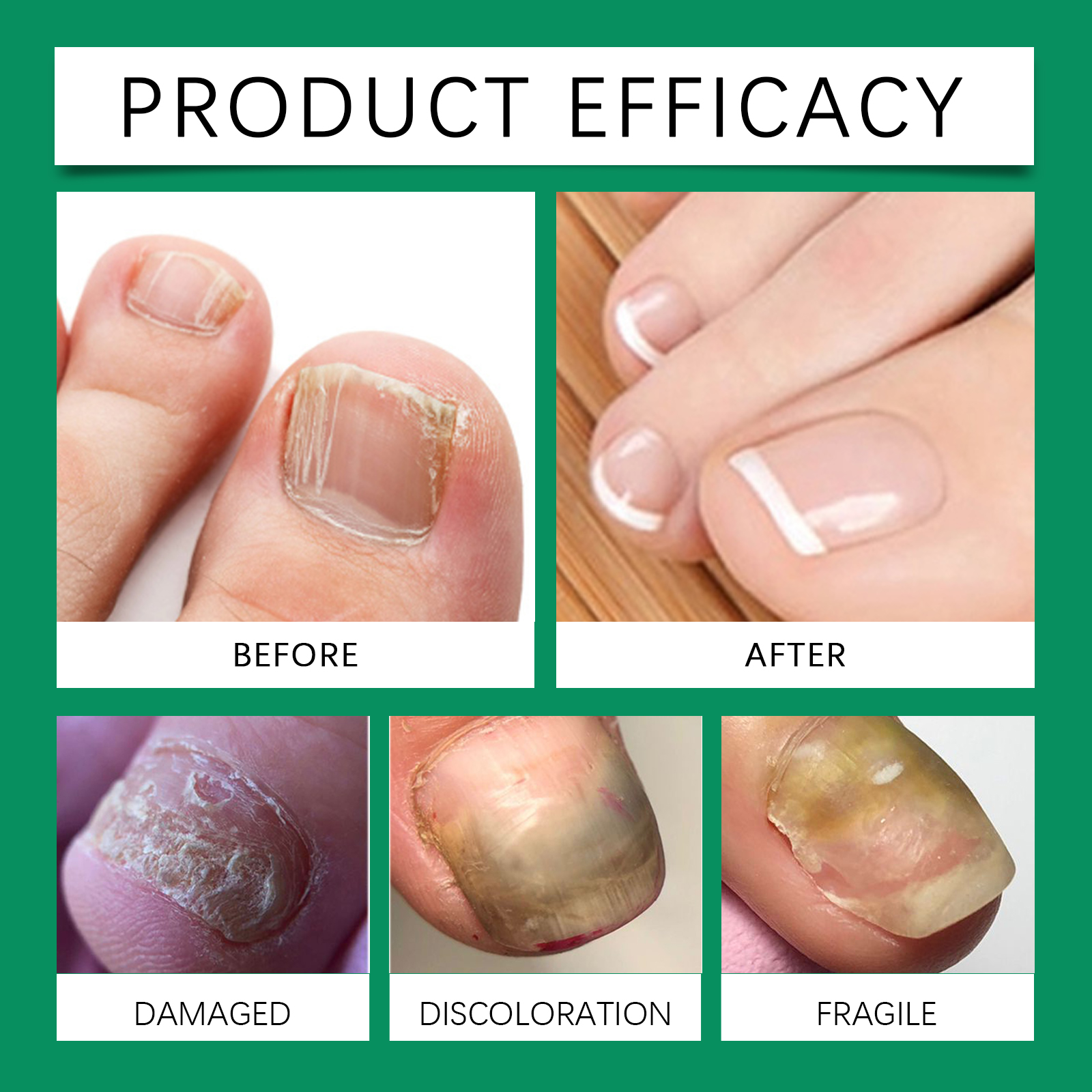 Anti-Fungal Nail Treatment Stick - Highly Effective for Multiple Nail ...