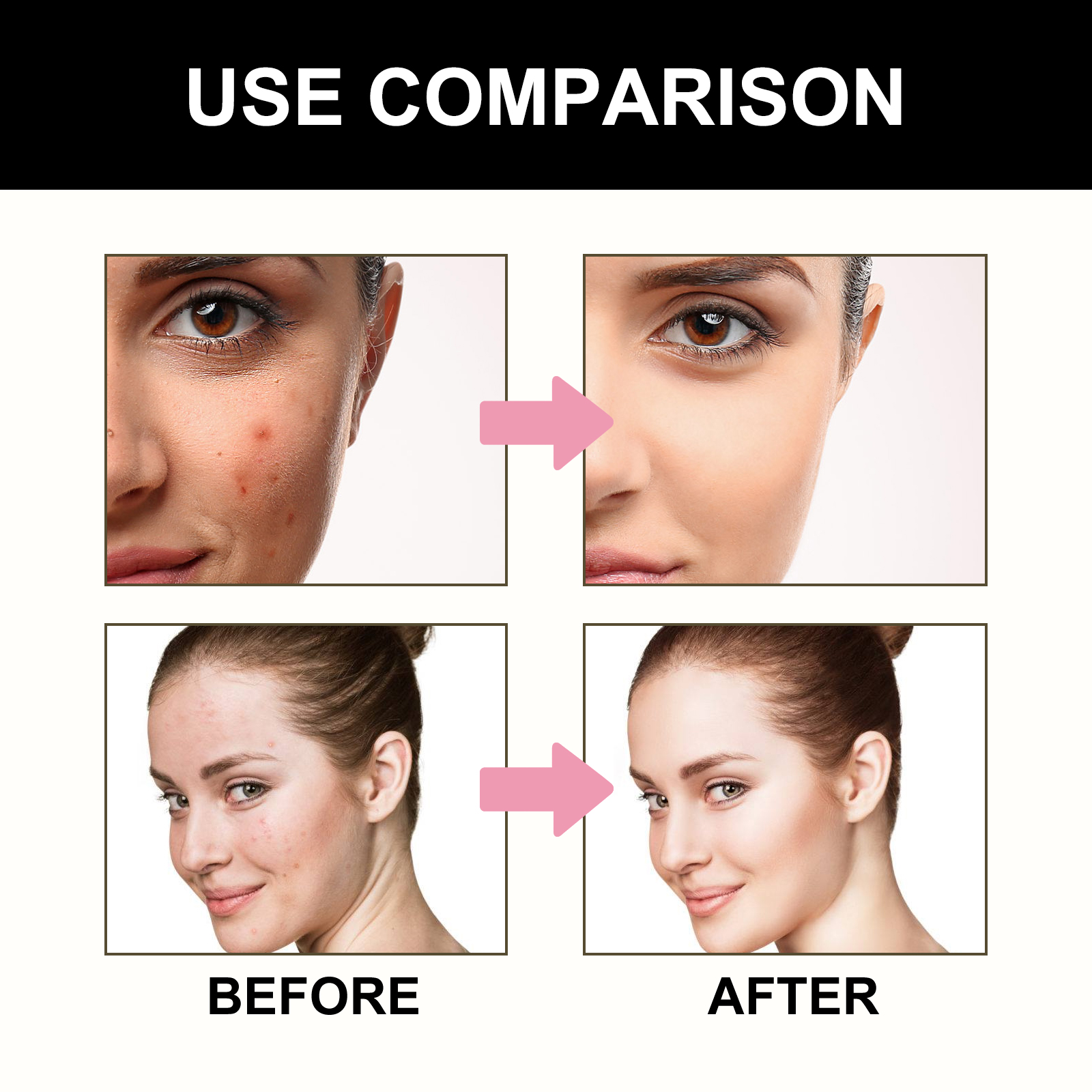 Acne Pimple Patch Waterproof Acne Cover Healing Pimple Remove Blackhead ...
