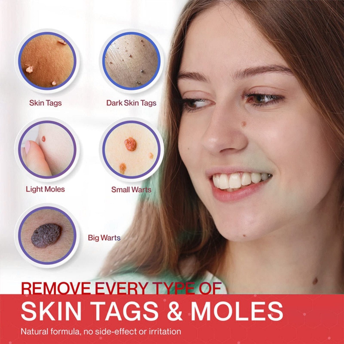 Moles and Skin Tags Removal Liquid Pen Against Papillomas, Warts, and ...