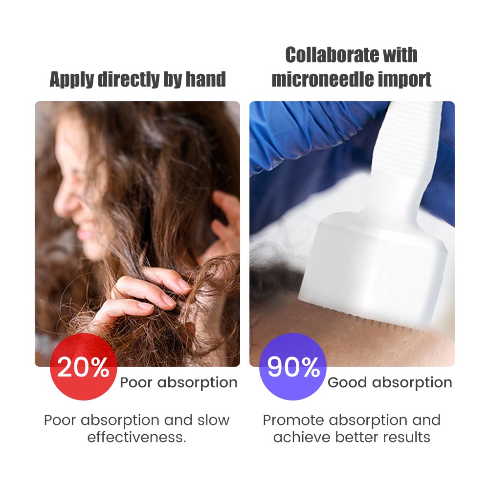 140 Titanium Microneedle Roller, 0.3mm Derma Stamp Pen for Home ...