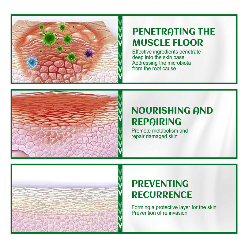 hair follicle cream, used to relieve folliculitis, relieve itching on ...