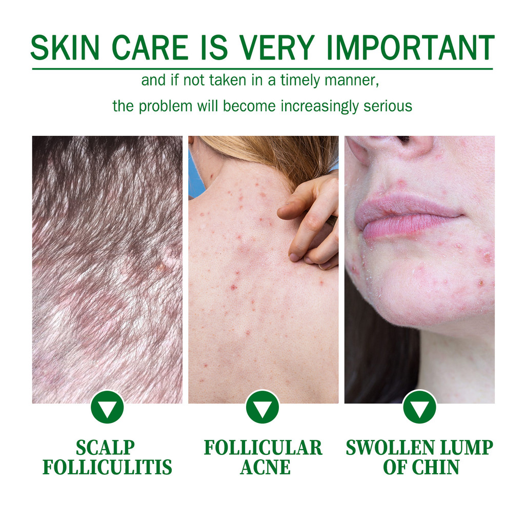 hair follicle cream, used to relieve folliculitis, relieve itching on ...
