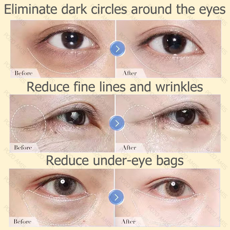 Eye repair cream Eyebags Remover Cream Eye Care For Dark Circles Anti ...