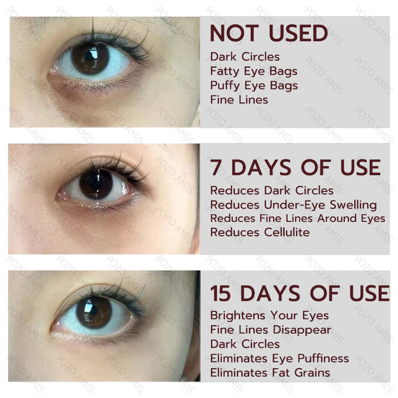 Eye repair cream Eyebags Remover Cream Eye Care For Dark Circles Anti ...