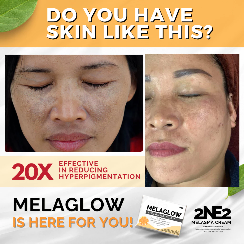 Buy1take1 Melasma Pekas Soap- Dark Spots, Melasma, Pekas ...