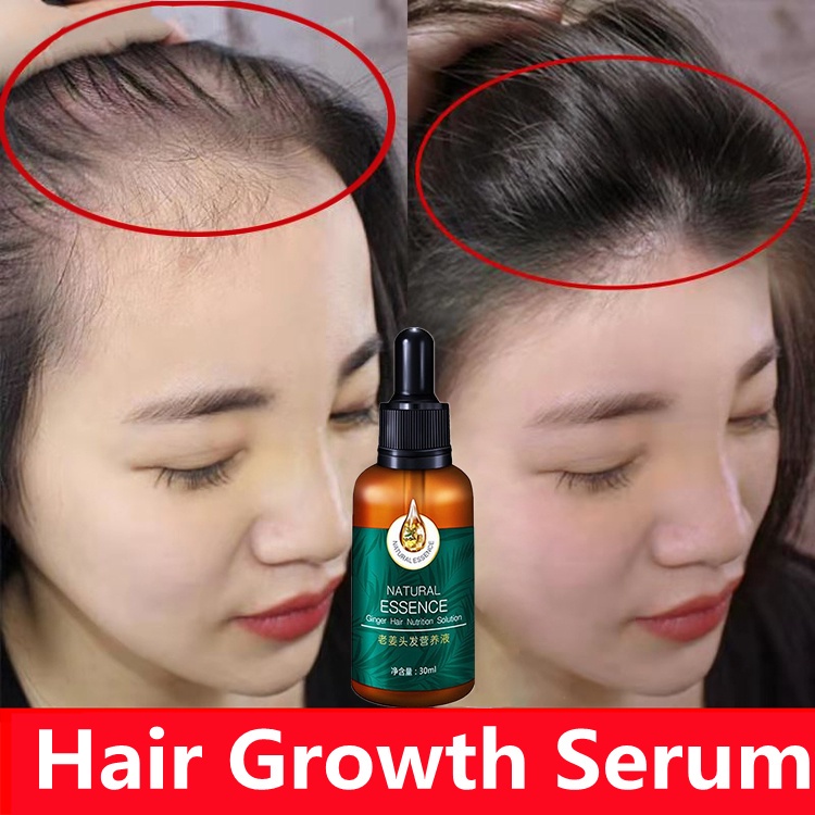 Hair Growth Serum Ginger Hair Treatment Essence Anti Hair Loss Spray ...