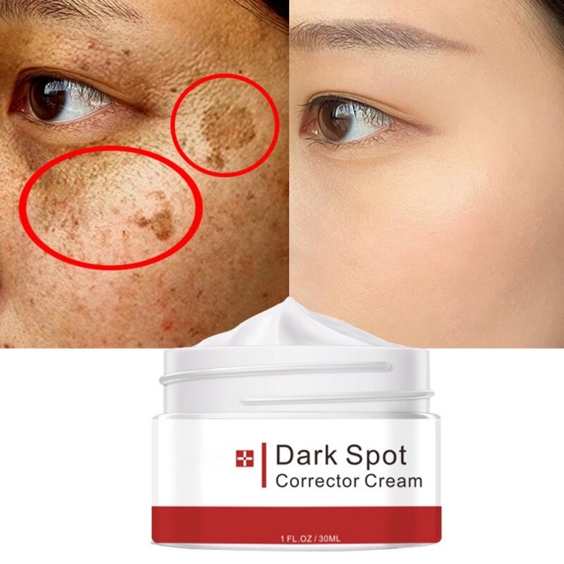 Black Spot Correction Creams Facial Body Black Spots Elderly Spots ...