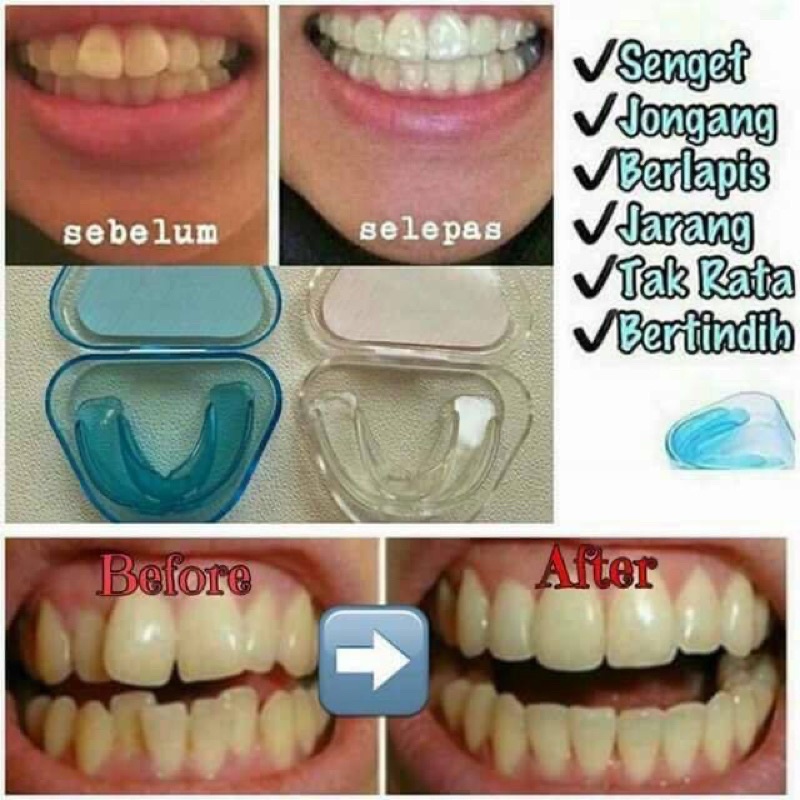 Teeth TRAINER Helps To Even TEETH, jongang, seget, Toothed Etc | Shopee ...