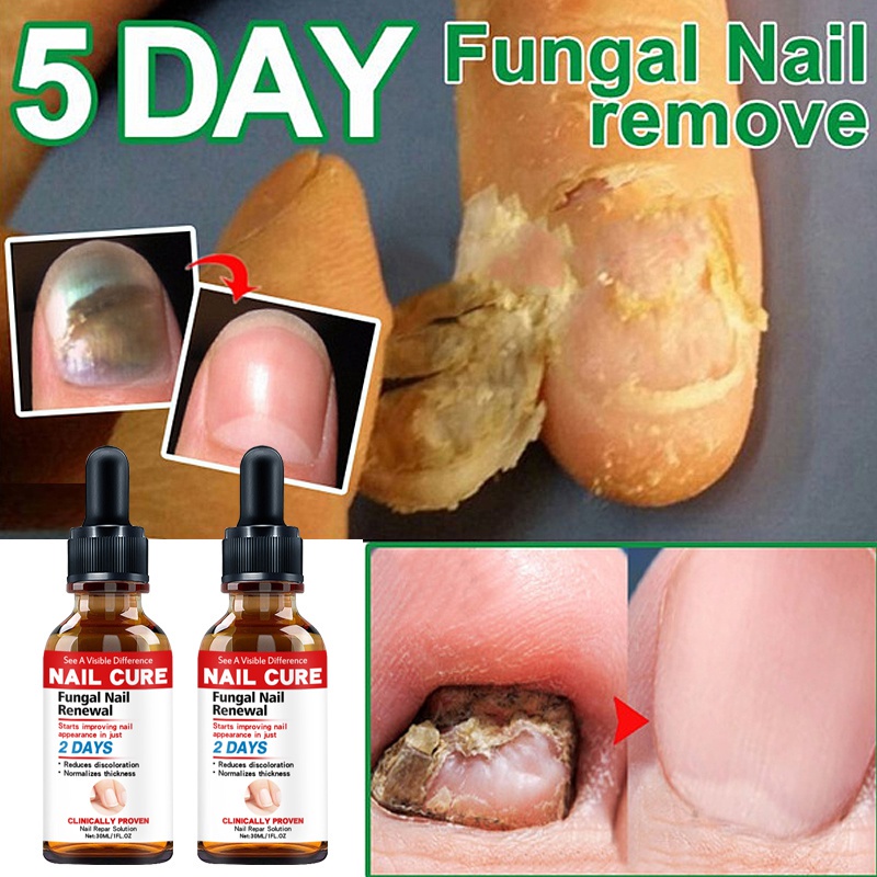 New Toenail Fungus Treatment Fungus Removal Treatment Anti Infection ...