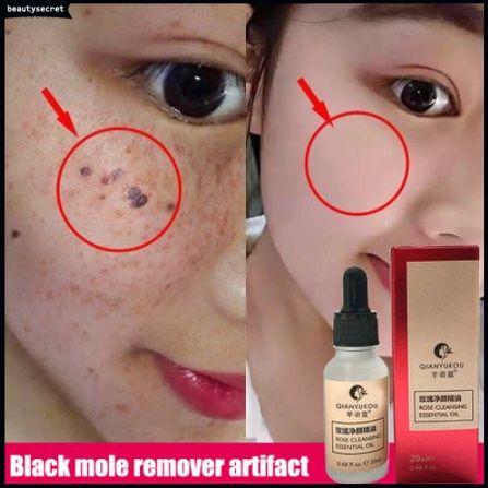 READY ORGANIC SKIN TAG SOLUTION SERUM/Tags Solutions Serum Mole and ...