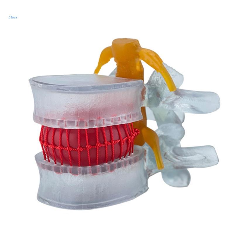 Chua Lumbar Disc Herniation Model Movable Lumbar Spine Model for ...