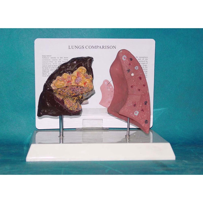Smoking lung and normal lung comparison model lung anatomy model ...