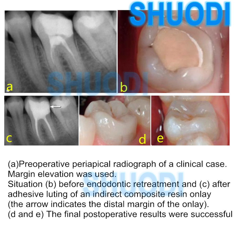 Dental Tofflemire Matrix for Deep Margin Elevation Large Curvature ...