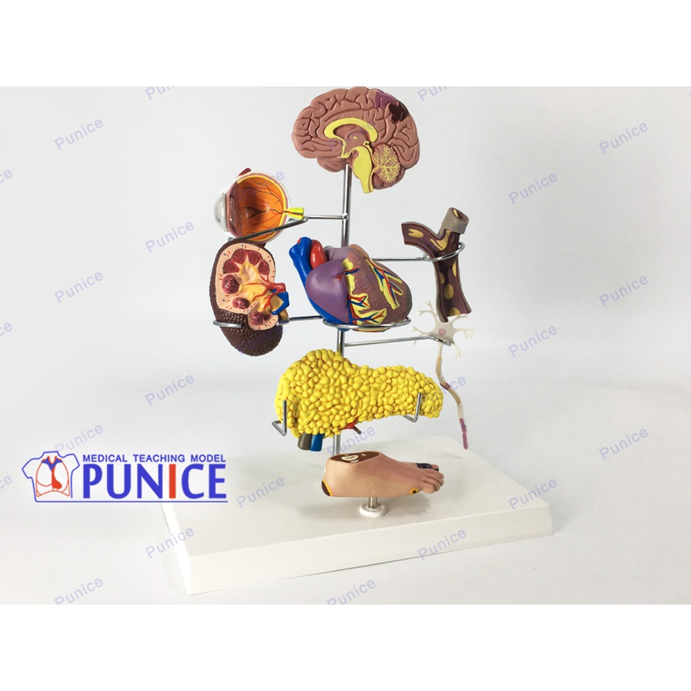 Diabetes Pathology Model Heart Model Kidney Model Eye Model Diabetic ...