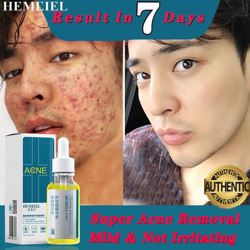 HEMEIEL- Plant acne repairing cream,acne scar remover pimple marks cream,Fast Acne Treatment ...