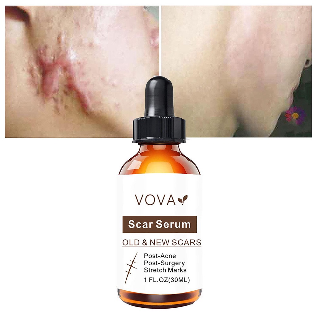 Natural Scar Serum Scar Removal Gel Moisturizing Scar Healer Scar ...