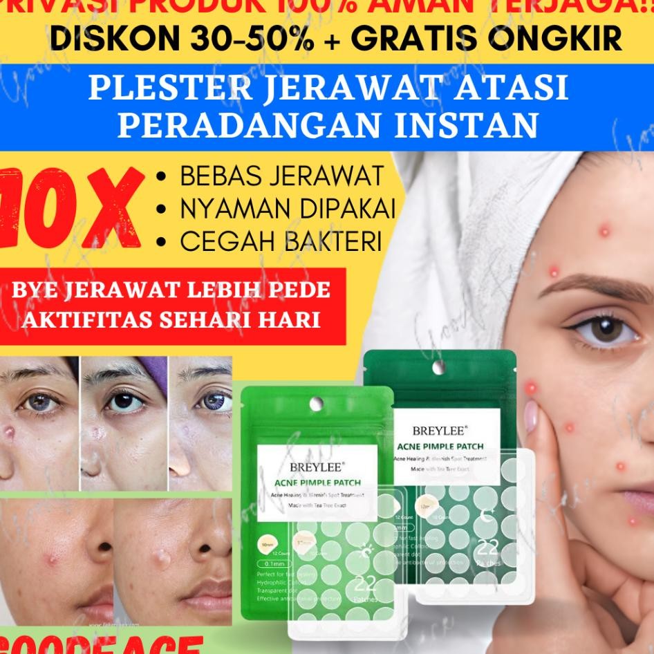 Breylee Acne Pimple Patch Daynht Remove Acne Tier 0.1Mm0.3 Mm | Shopee ...