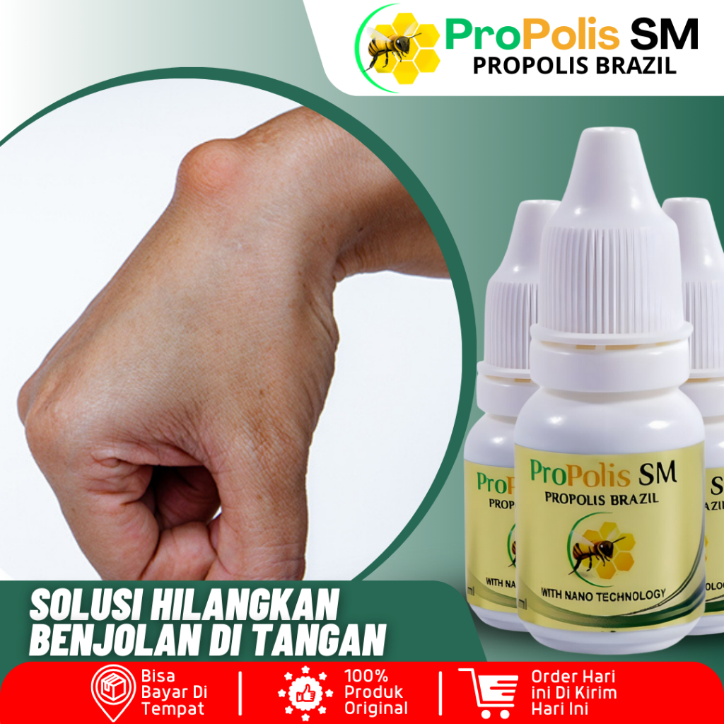 Drug Lumps On The Wrist Cyst Ganglion Lipoma Fat Lump ProPolis SM ...