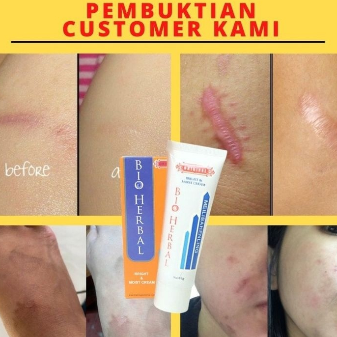 Meilibahenling Scar Removal Scabs Smallpox Pockmarks Acne Burns Exhaust ...