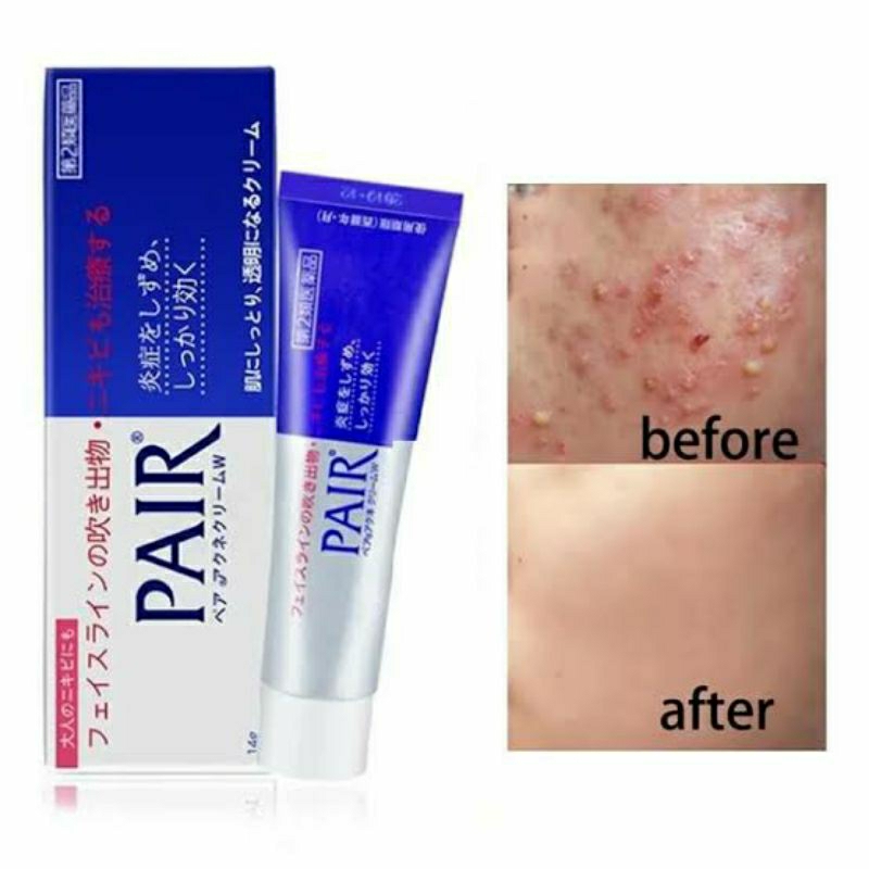 Lion pair acne cream 24gram acne gel spot care anti acne made in japan ...