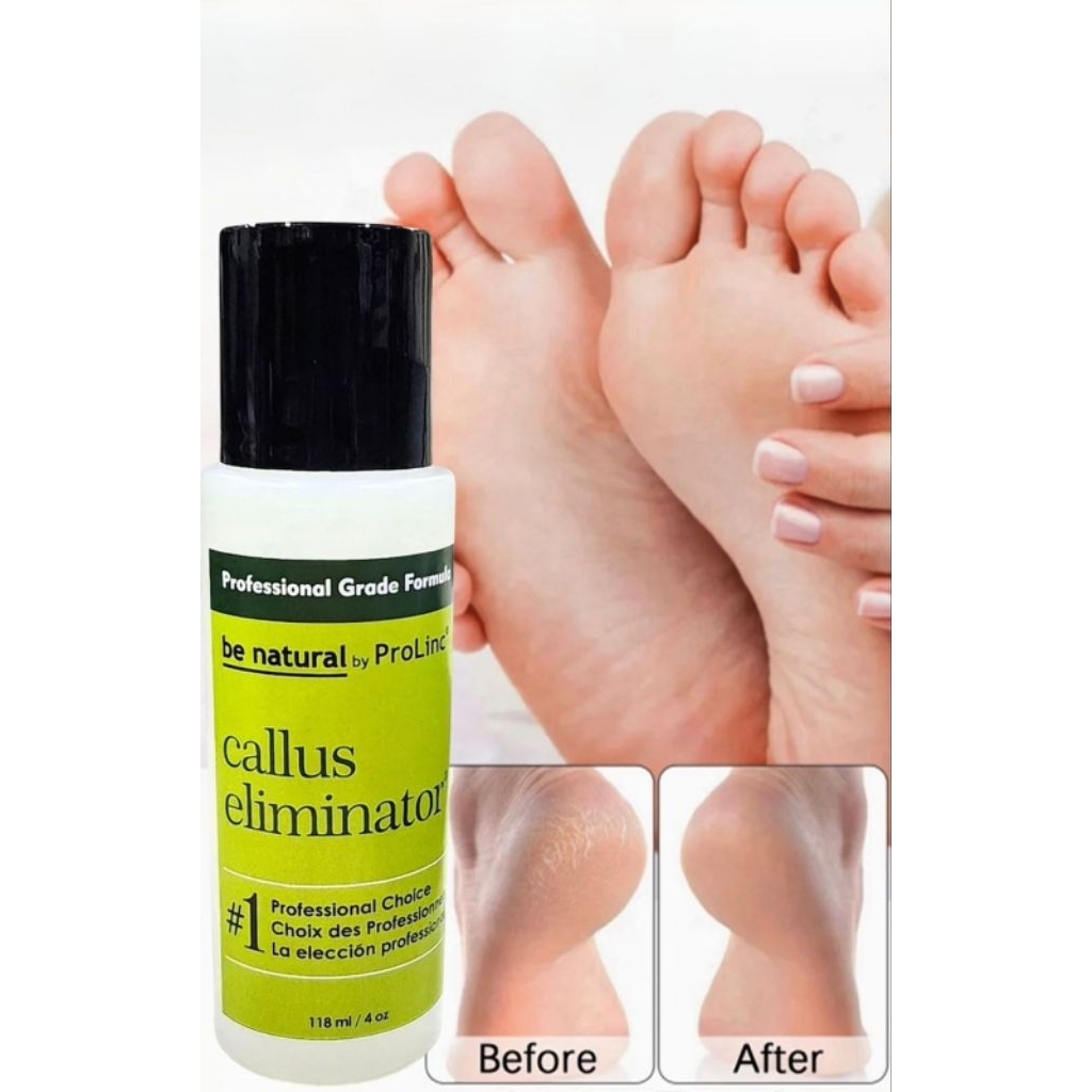 Prolinc Be Natural Callus Eliminator 4oz/118ml (foot Callus medicine ...