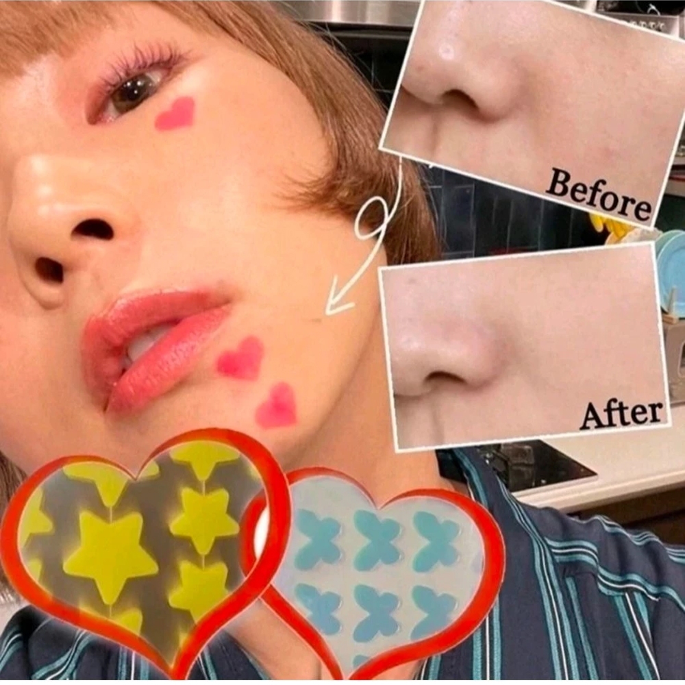 Acne patch | Pimple patch | Acne sticker | Acne remover acne cover per ...
