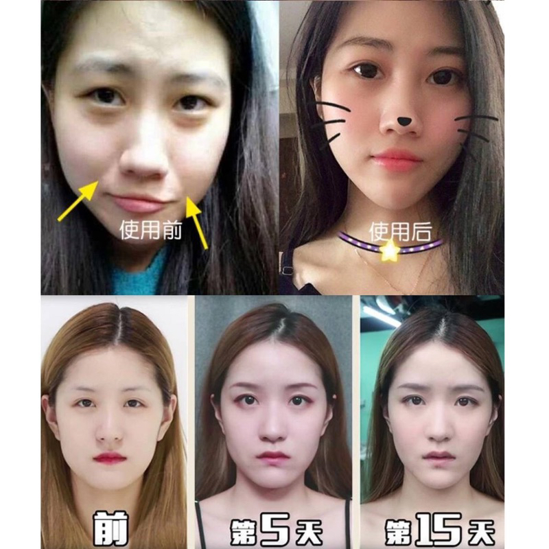 V-shape Oral Gymnastics Tool This Chin Exercise Tool Can Tighten The ...