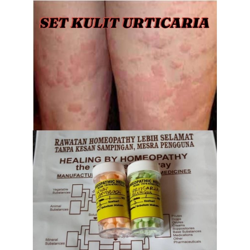 SET URTICARIA (alergik_kulit) | Shopee Philippines