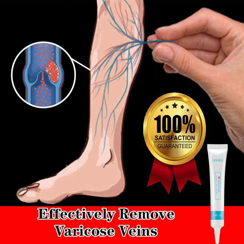 Varicose Vein Treatment Cream Vasculitis Phlebitis Spider Ointment ...