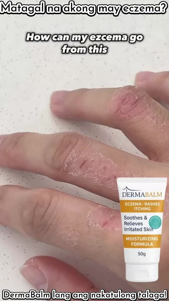 Derma Balm ECZEMA RASHES ITCHING Cream - 50g | Soothes & Relieves ...