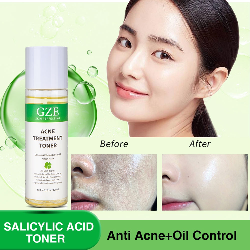 GZE Salicylic Acid 2% Solution Anti Acne Pimples Treatment Soothing Oil ...