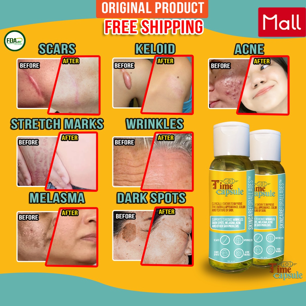 Timecapsule Original Scars Peklat Melasma Pekas Keloids Acne Blackhead ...