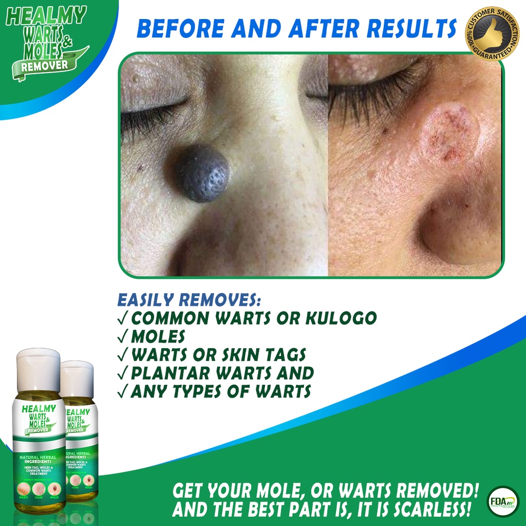 HEALMY WARTS REMOVER MOLE REMOVER GOODBYE NUNAL | Shopee Philippines