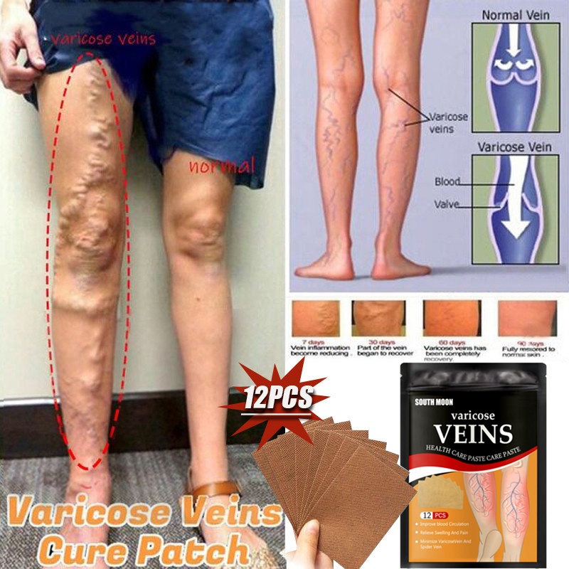 [FDA]12PCS/Pack Varicose Veins Patch Varicos Vein Treatment Treatment ...