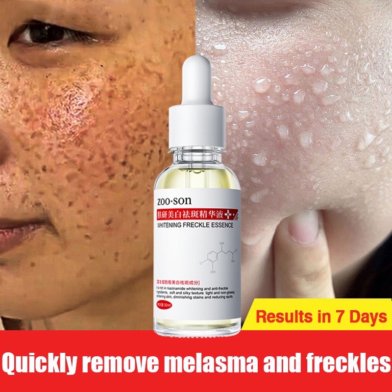 30ml Pekas Remover Serum For Melasma And Dark spot Melasma Serum Pekas ...