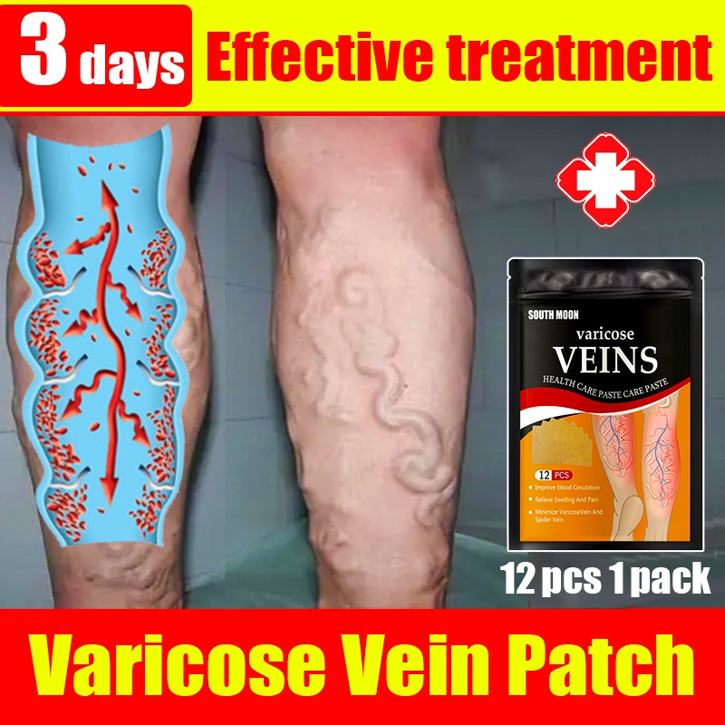 Varicose Veins Plaster Original Varicose Veins Effective Remover Patch ...