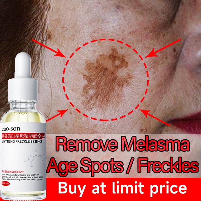 30ml Melasma Serum Pekas Remover Collagen Pekas Serum Melasma Dark Spot ...