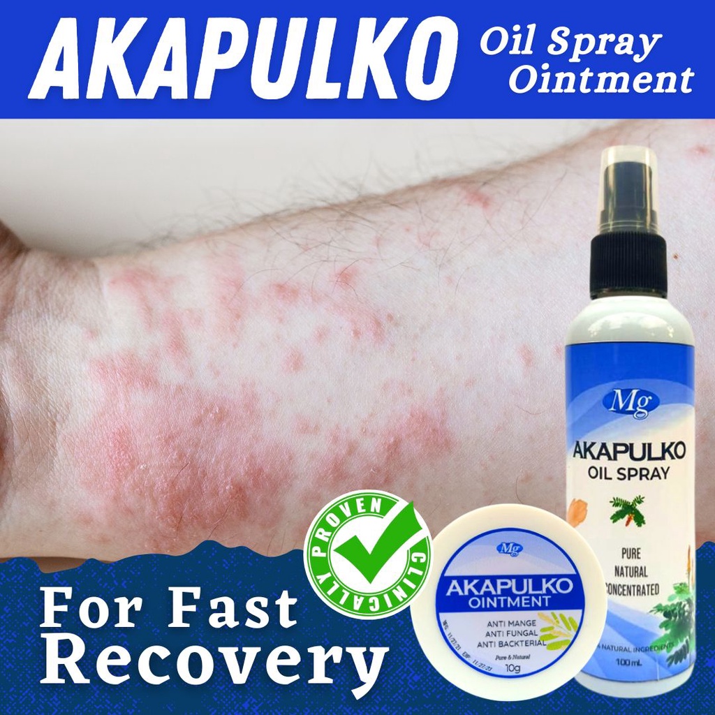 BUNDLE SET Akapulko Oil Spray and Ointment | Treat Different Skin ...