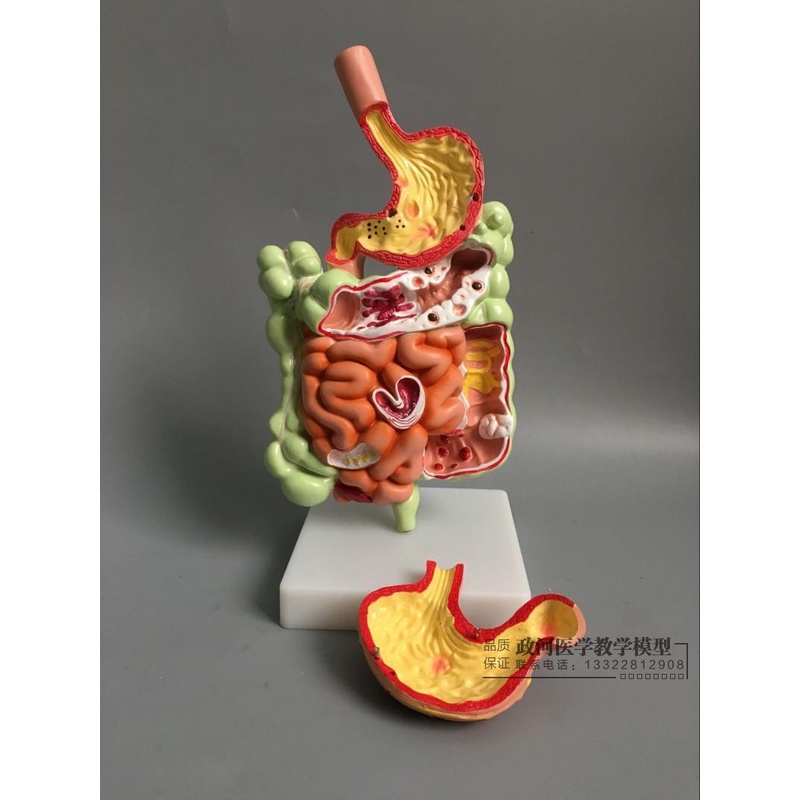 Human gastrointestinal pathology model digestive tract gastric coronal ...