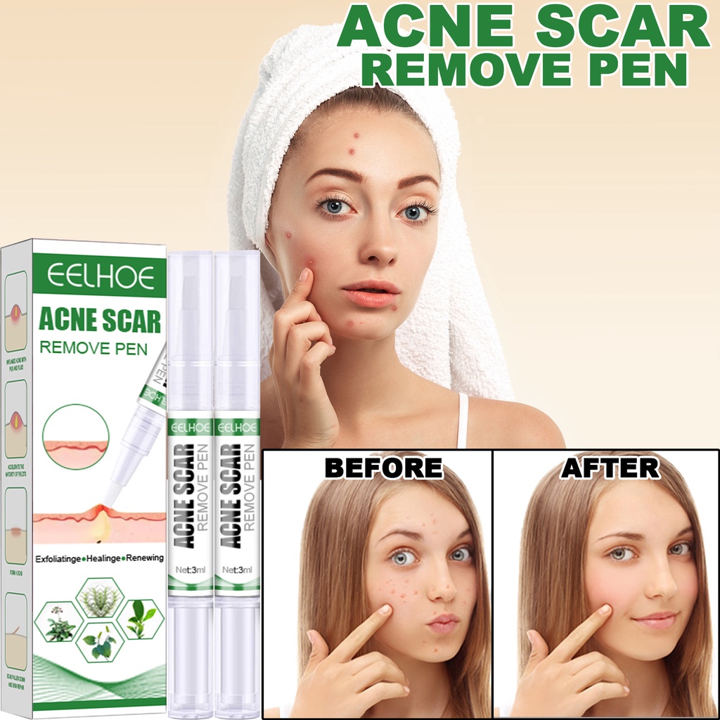 Acne Scars Remover for face Acne Scars cream serum Pimples remover ...