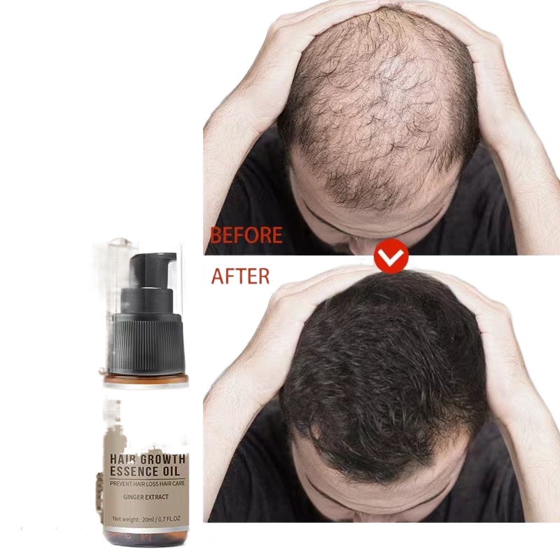 ☜purc Hair Growth Essence Oil Anti Hair Fall Treatment 20ml Shopee