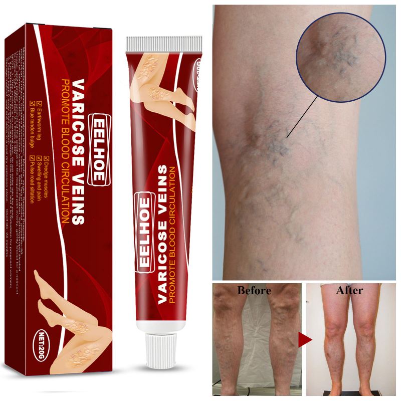 Varicose Veins Treatment Cream Relieve Legs Tired Dilated Vasculitis ...