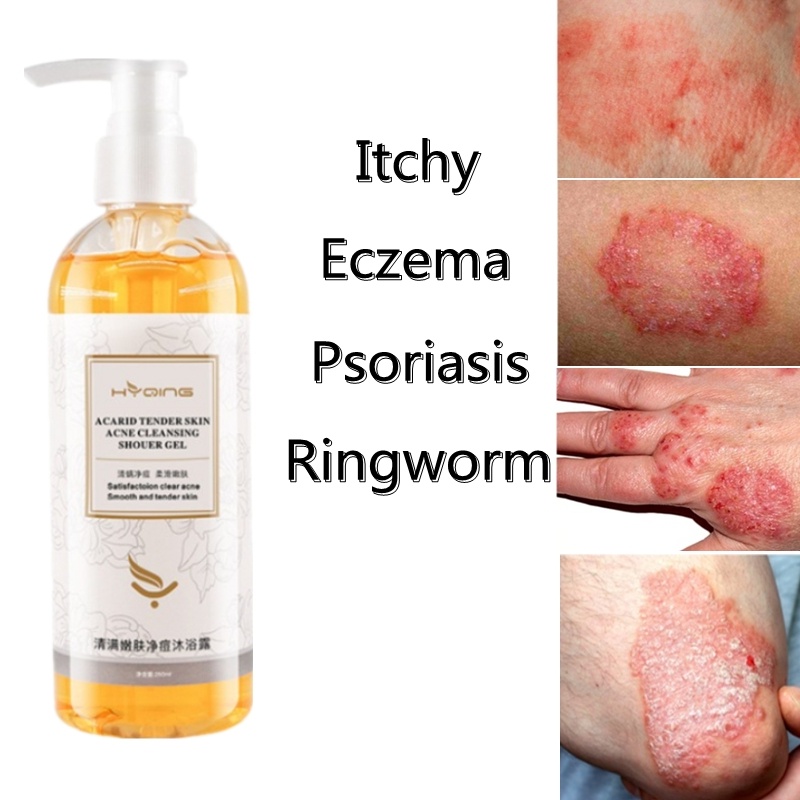Eczema Treatment Removal Eczema Psoriasis Ringworm Relieve Itching ...